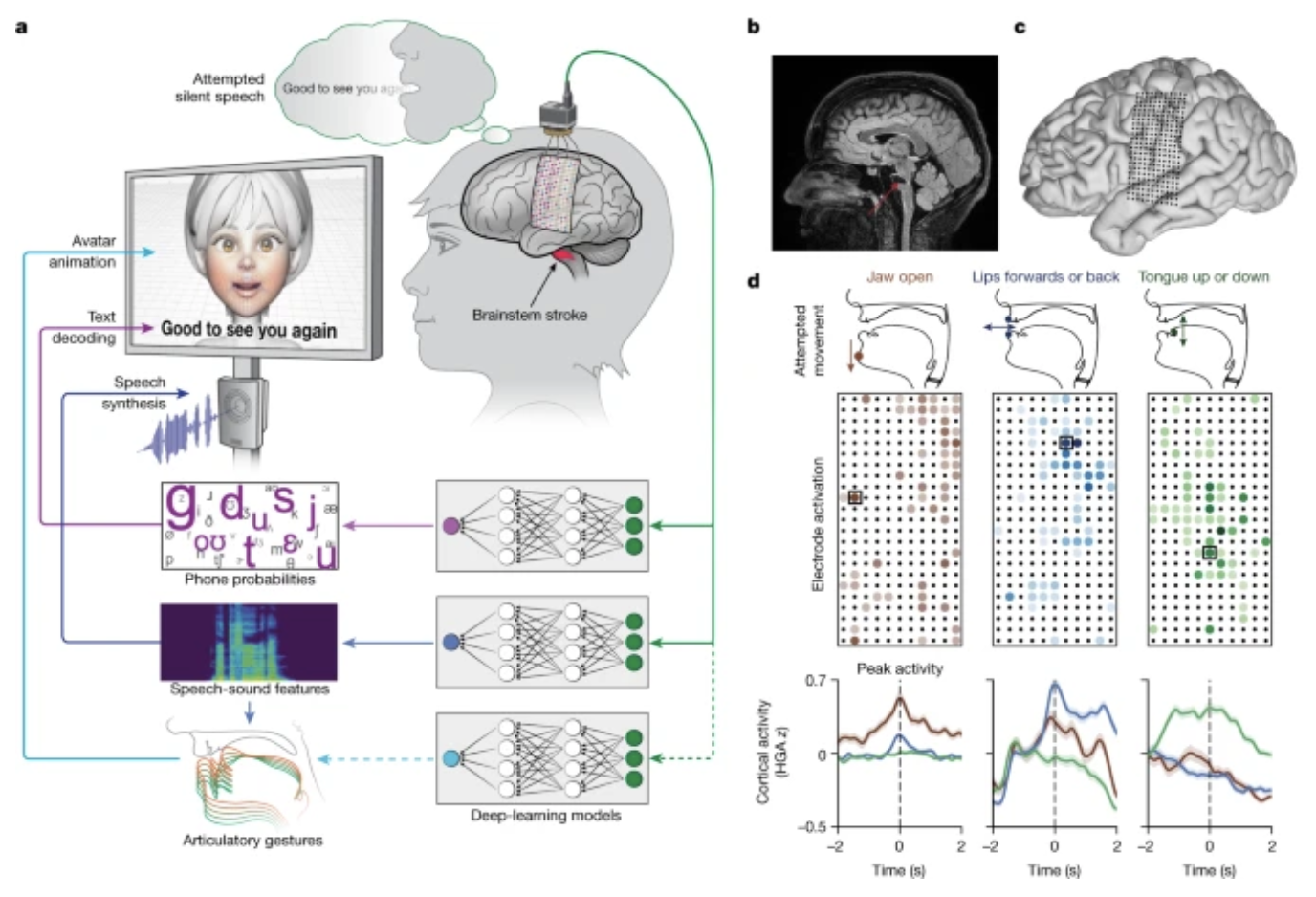 Telepathic Technology: Novel Brain Implants Help Paralyzed Patients ...