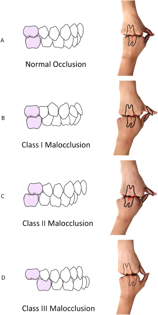 Effect of Dental Malocclusions on Posture in Children