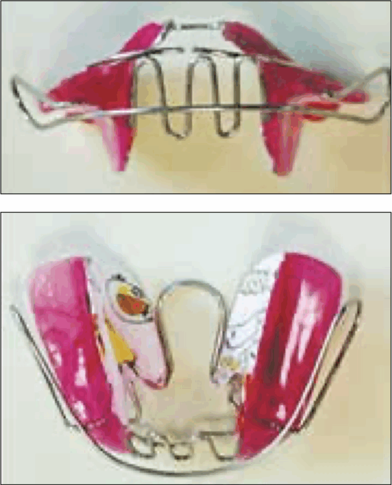 Effect of Dental Malocclusions on Posture in Children